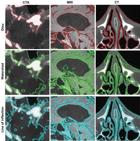 Segmentations Obtained Notes Using The Otsu Method Watershed Method Download Scientific