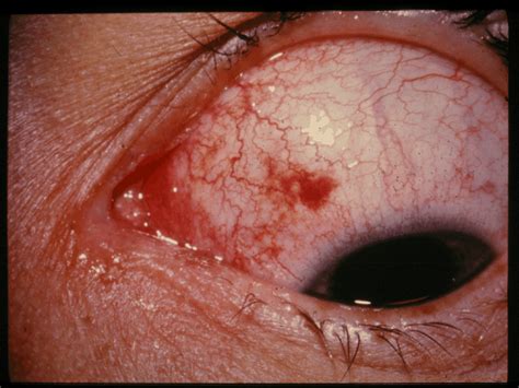 Conjunctivitis — Taming The Sru