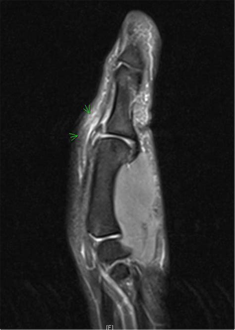 Mri Of An Old Avulsion Fracture Of The Ucl Insertion Download
