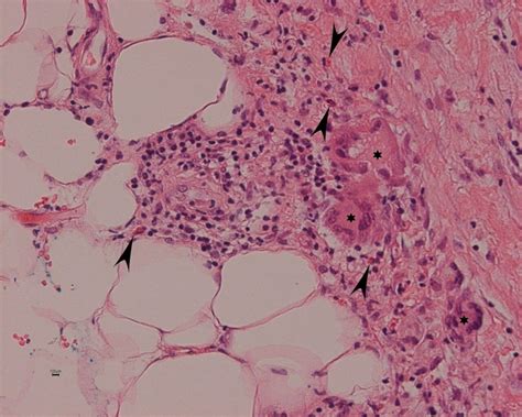 Eosinophilic Fasciitis BMJ Case Reports