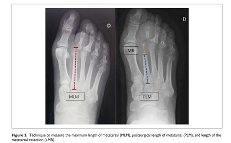 Left Ankle Splint Cpt Code At Tawny Dunn Blog