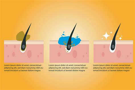 Cleaning Blackheads Process Flat Illustration Clogged Pores Removal