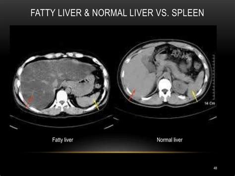 liver ppt pptx liver computed tomography pptx