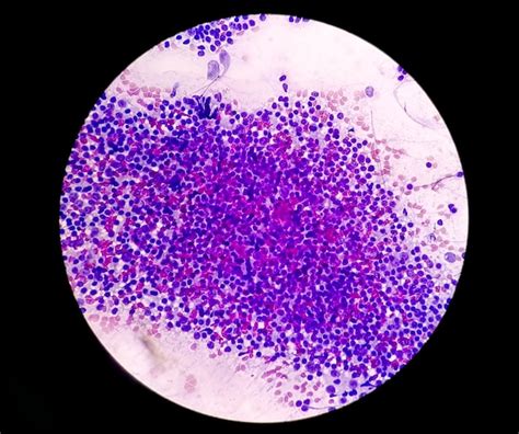 40 Lymphadenitis Pictures