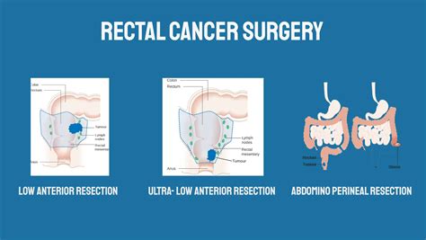 Rectal Cancer Surgery Surgery For Colon Cancer Macmillan Cancer