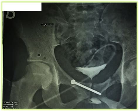 Combined Antegrade And Retrograde Cystourethrography Showing A