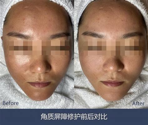 泰醫源美容專家與您聊一聊敏感肌到底怎麼護理？ 每日頭條