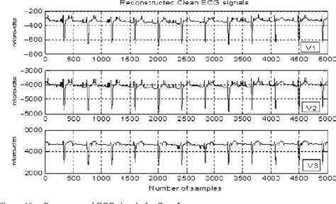 Figure 18 From Detection Of Indeterminacies In Corrected Ecg Signals