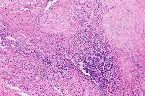 Acute Pancreatitis Gross