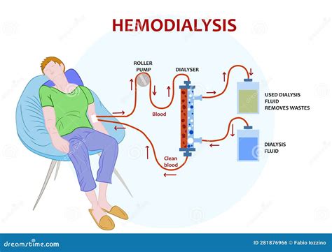 Components Of Hemodialysis Diagram Hemodialysis Machine Proc