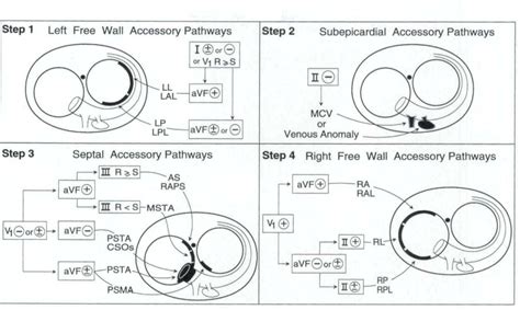 Stepwise Ecg Algorithm For Predicting Accessory Pathway