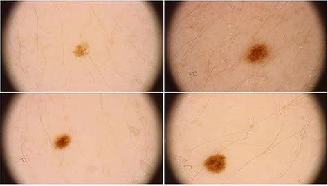 Digital Dermoscopy Of Others Nevi Located On The Abdomen And Back Download Scientific Diagram Digital Dermoscopy Of Others Nevi Located On The Abdomen And Back Download Scientific Diagram