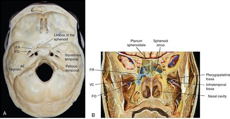 Middle Cranial Fossa Middle Cranial Fossa Quiz
