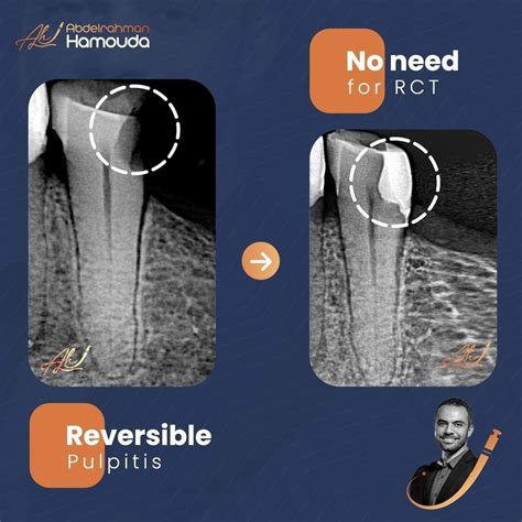 Abdelrahman Ali Hamouda On Linkedin Endotipoftheday