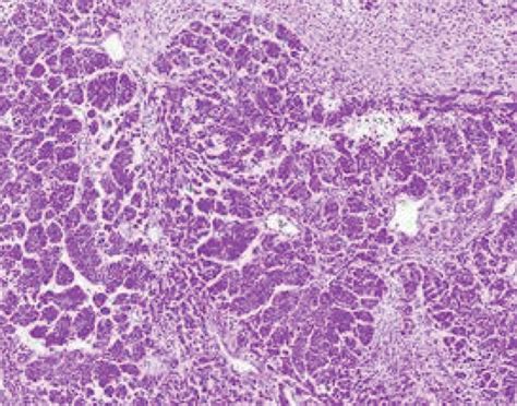 A Primitive Neuroectodermal Tumor Component Present In The Testicular Download Scientific