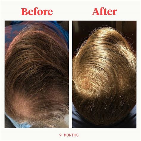 Keeps Hair Review Must Read This Before Buying