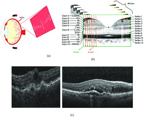 Retinal Layers And Abnormalities In Oct Image [2] A Retinal Layers Download Scientific