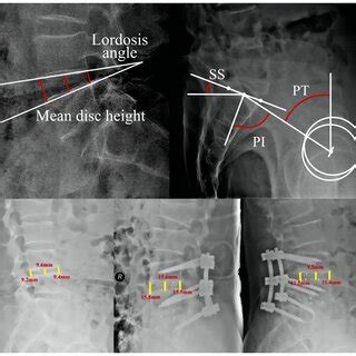 Diagram Of The Measurement Of Imaging Data PI Pelvic Incidence SS Download Scientific