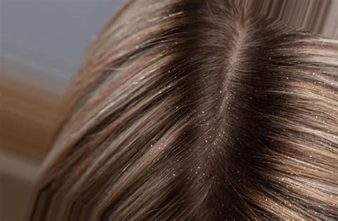 Hair Disease Detection Object Detection Dataset By Project