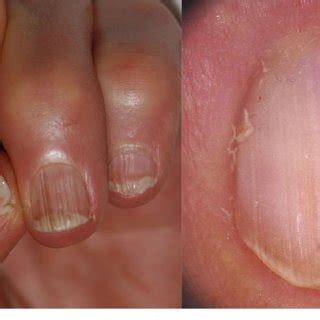 Onychorrhexis Presenting As Single Longitudinal Split Of Nail Plate