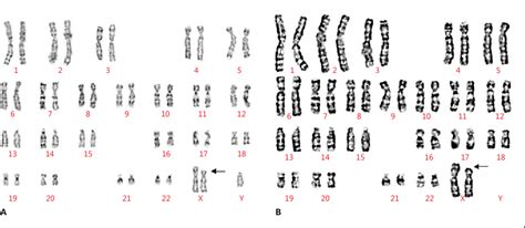 Deletion Karyotype