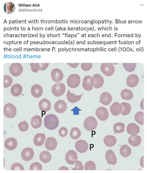 Schistocytes • The Blood Project