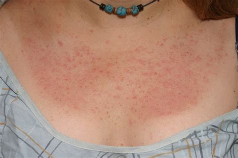 Polymorphous Light Eruption Symptoms Causes Risk Factors Diagnosis Polymorphous Light Eruption Symptoms Causes Risk Factors Diagnosis