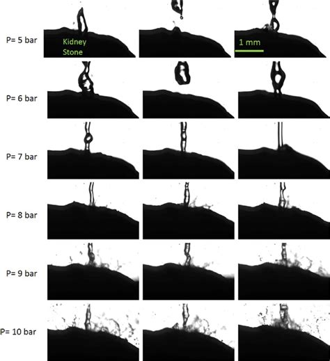 Interactions Between The Cavitating Flow And Urinary Stone At Upstream Download Scientific
