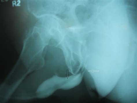 Urethro Urethral Fistula A Rare Cause Of Post Turp Incontinence Pmc