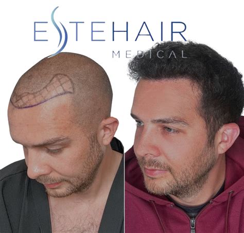 Exosome Hair Loss Treatment Este Hair Medical