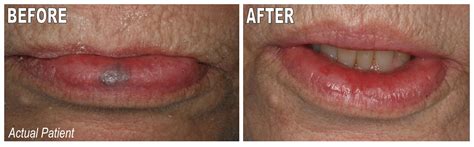 Laser Lip And Gum Depigmentation Periodontist In Denver Co