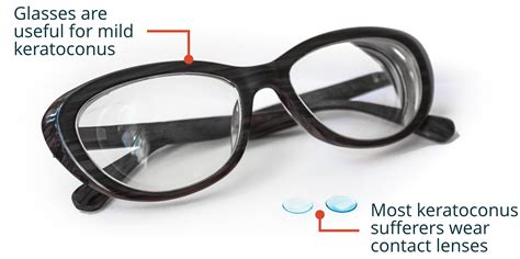 Do Eye Drops Help Keratoconus At Sheila Tejada Blog