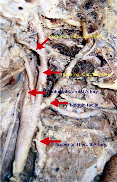 External Carotid Artery Branches Cadaver External Carotid Artery Branches Cadaver