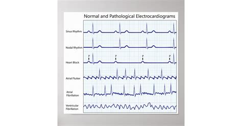 Normal And Pathological Ecg Poster Zazzle