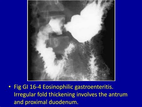 16 Simultaneous Involvement Of The Gastric Antrum And Ppt