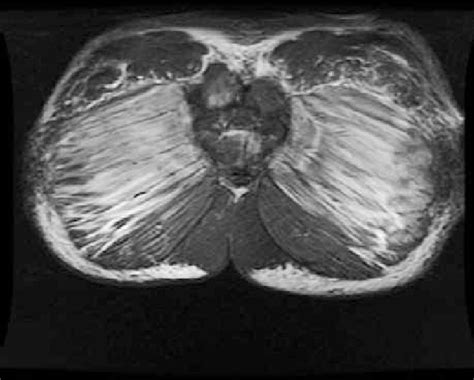 Figure Magnetic Resonance Imaging Showing Extensive Edema Within The