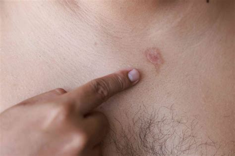 Stages Of Pityriasis Rosea Pictures And What To Know