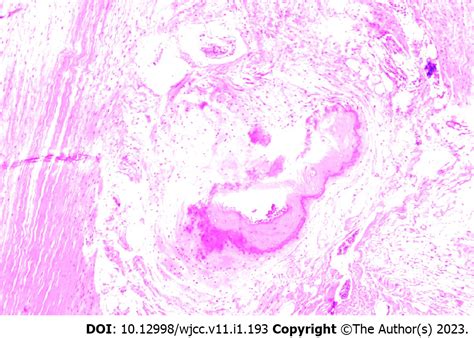 Post Traumatic Heterotopic Ossification In Front Of The Ankle Joint For