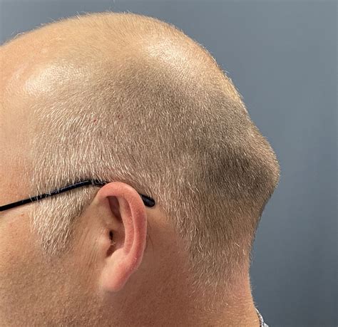 Occipital Protuberance Bump