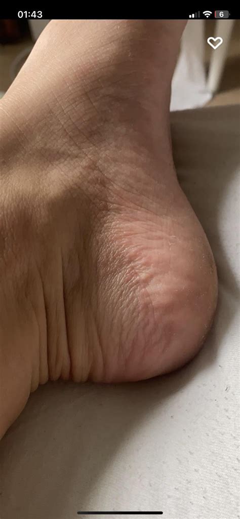 Very Itchy Rash On Hands And Feet R Skin