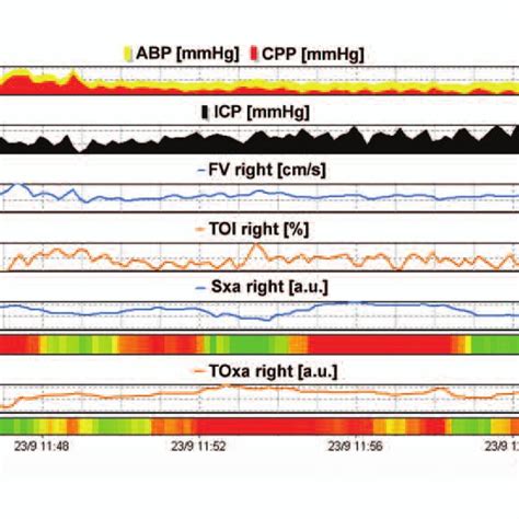 Example Of Multimodal Neuromonitoring Of A Patient 4 Days After Sah