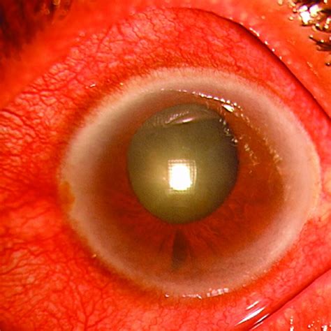 This Photograph Shows An Example Of Van Herick ́s Grade Iii Considered