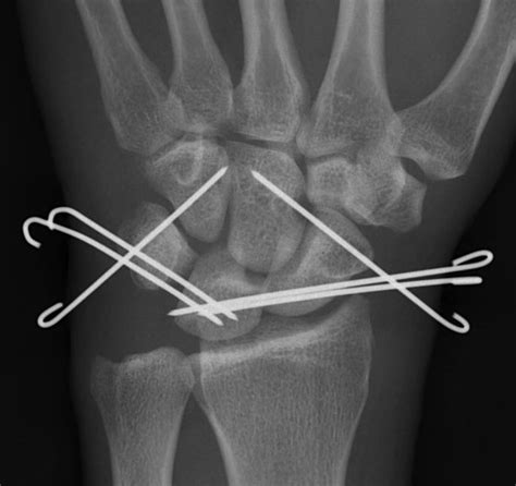 Perilunate Dislocations The Bone School