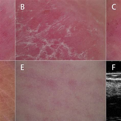 Clinical Dermoscopic And Ultrasonic Assessments Before And After