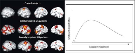 Left Functional Brain Activation During A Tonic Alertness Task In