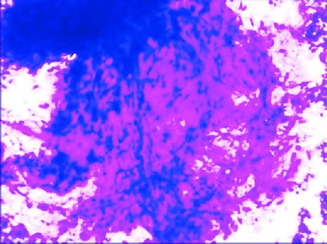 Photomicrograph Showing Classic Pattern In Synovial Sarcoma Branching Download Scientific