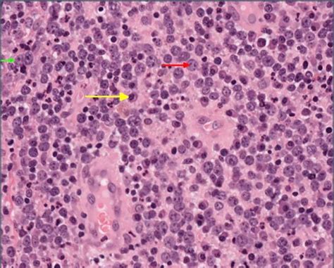 High Power View Showing Abundant Large Lymphocytes With The Morphology