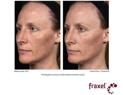 Fraxel Dual — North Point Dermatology And Mohs Surgery