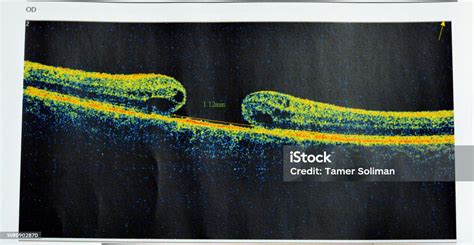 Oct Of The Eye Reveals Faint Epimacular Membrane And Full Thickness