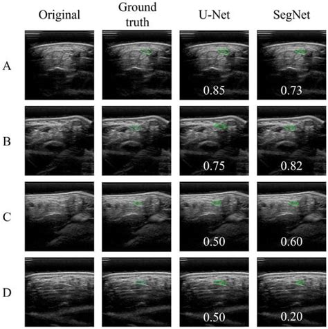 Convolutional Neural Network Approaches In Median Nerve Morphological Assessment From Ultrasound